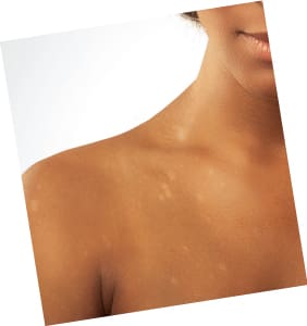 10 Things About...Hypopigmentation - dermascope