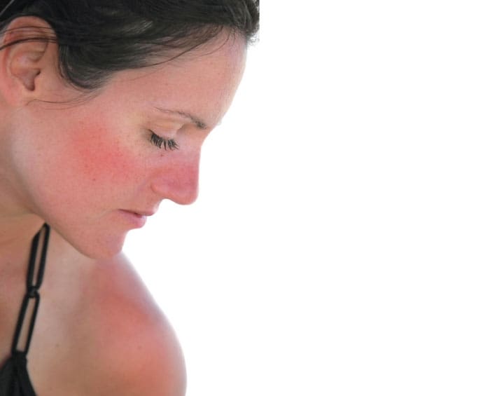 Soothing Sunburns with an Integrative Approach - dermascope