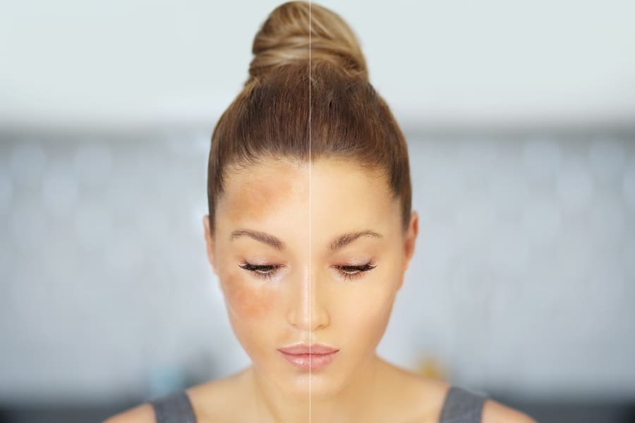 LED Light Therapy and Hyperpigmentation - dermascope