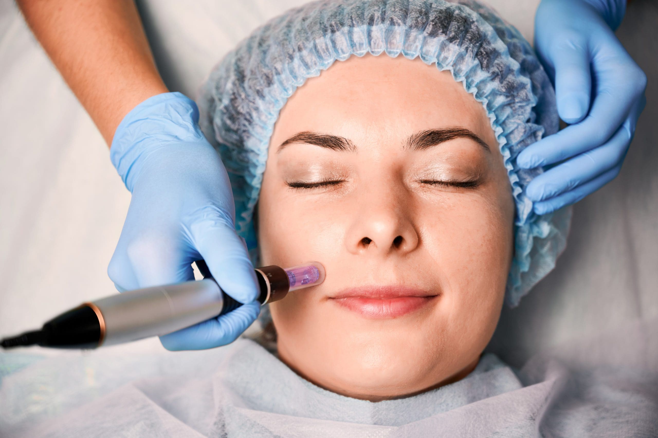 The Microneedling Glow Up - dermascope